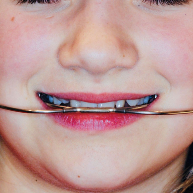 behandeling - Orthodontie Benijts