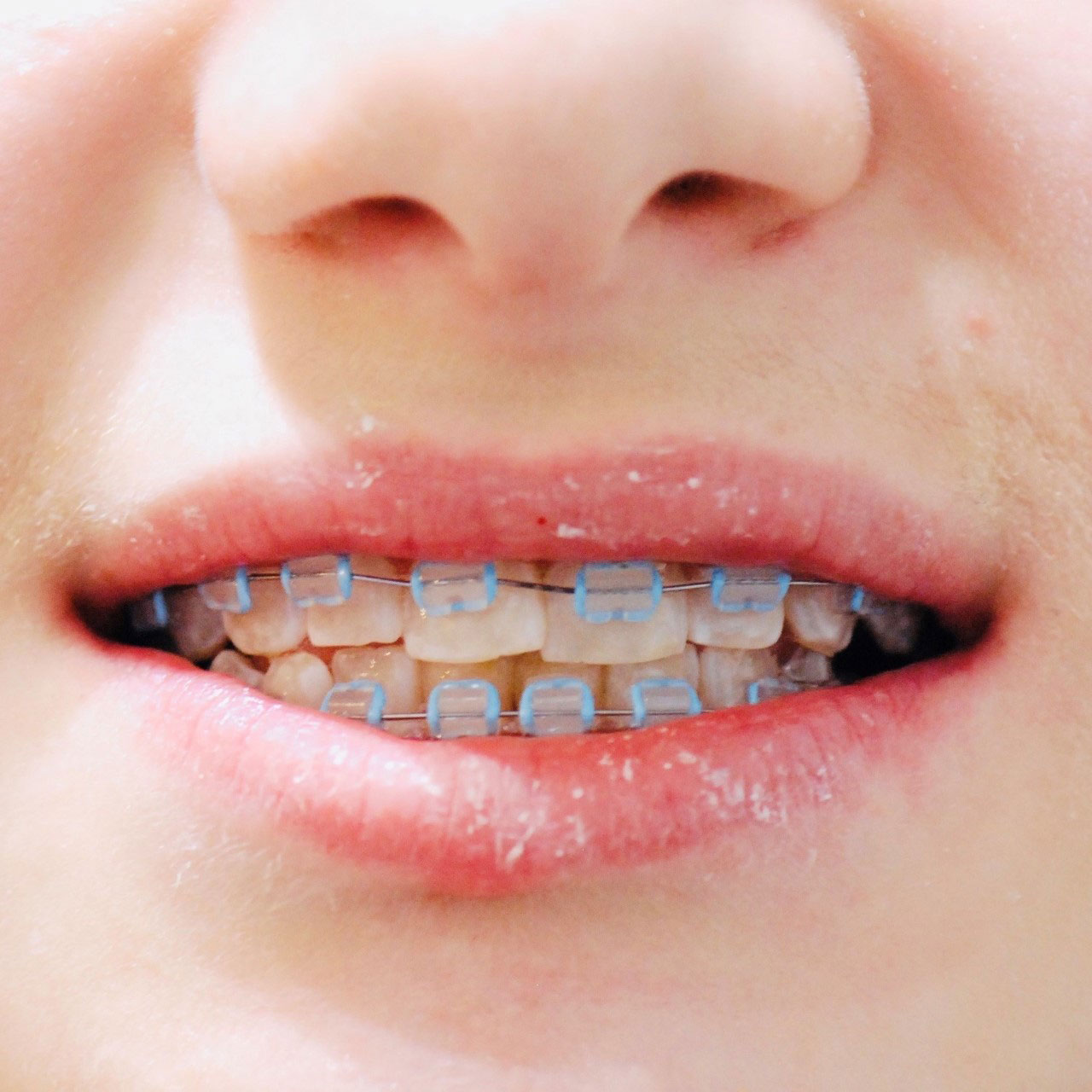 behandeling - Orthodontie Benijts
